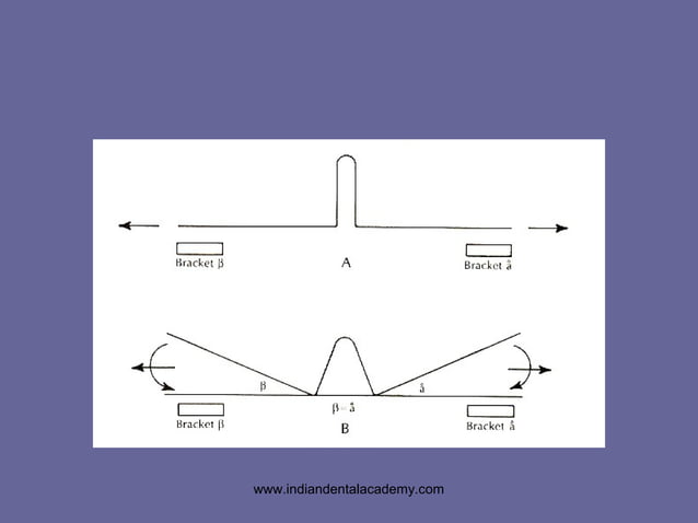 Burstone’s T Loop | PPT