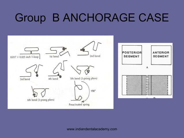 Burstone’s T Loop | PPT