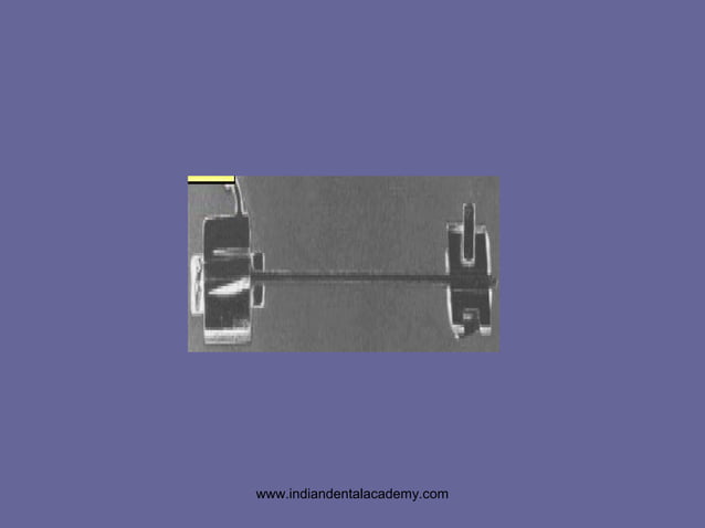 Burstone’s T Loop | PPT