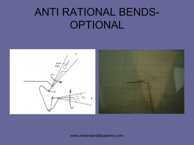 Burstone’s T Loop | PPT