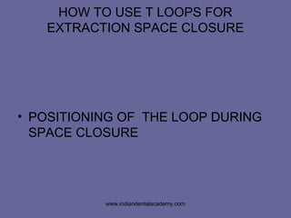 Burstone’s T Loop | PPT