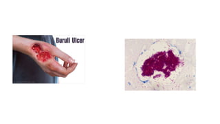 BURULI ULCER.pptx, MEDICAL MICROBIOLOGY. | PPTX