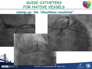 Burzotta F 201111 | PPT