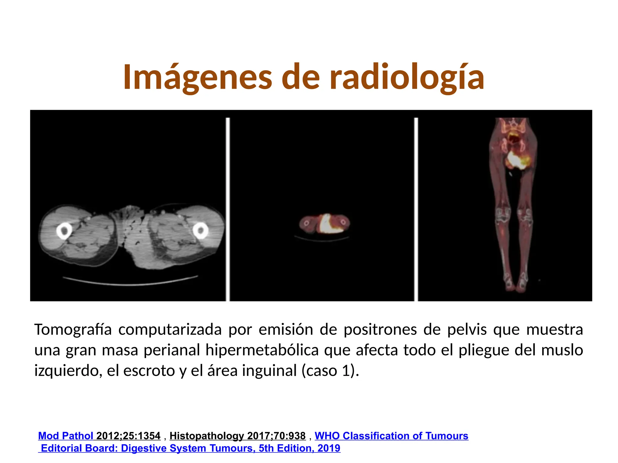 Buschke-Löwenstein-JOSE ANIBAL CORDOVA MASIAS.pptx