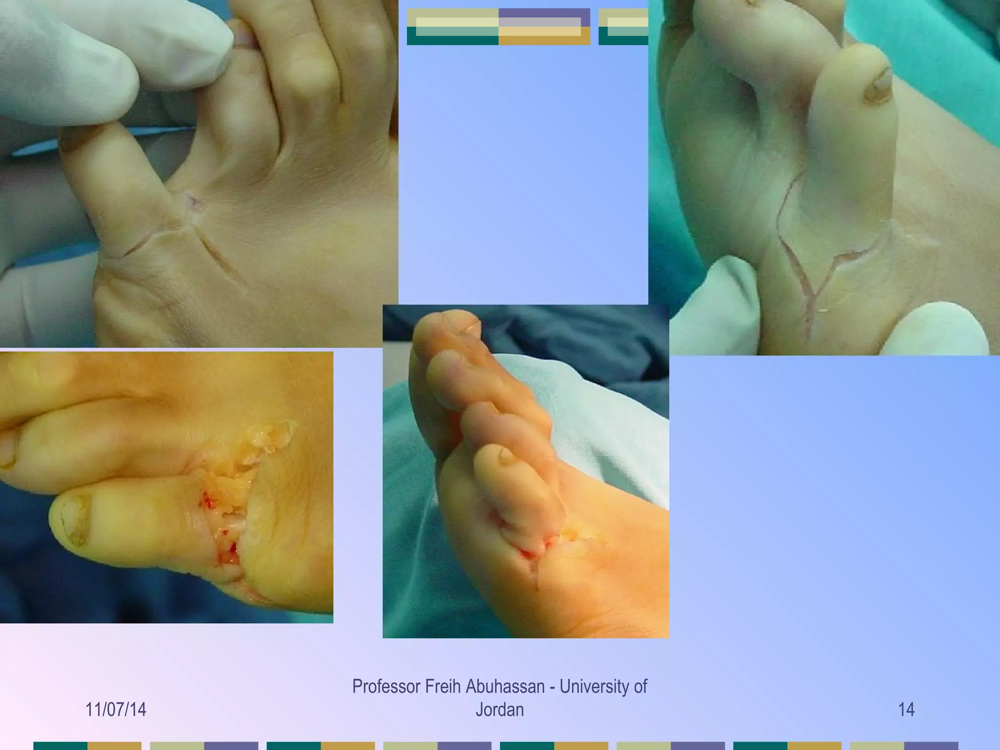 Butler's procedure overriding 5th toe - البروفيسور فريح عوده ابوحسان | PPT