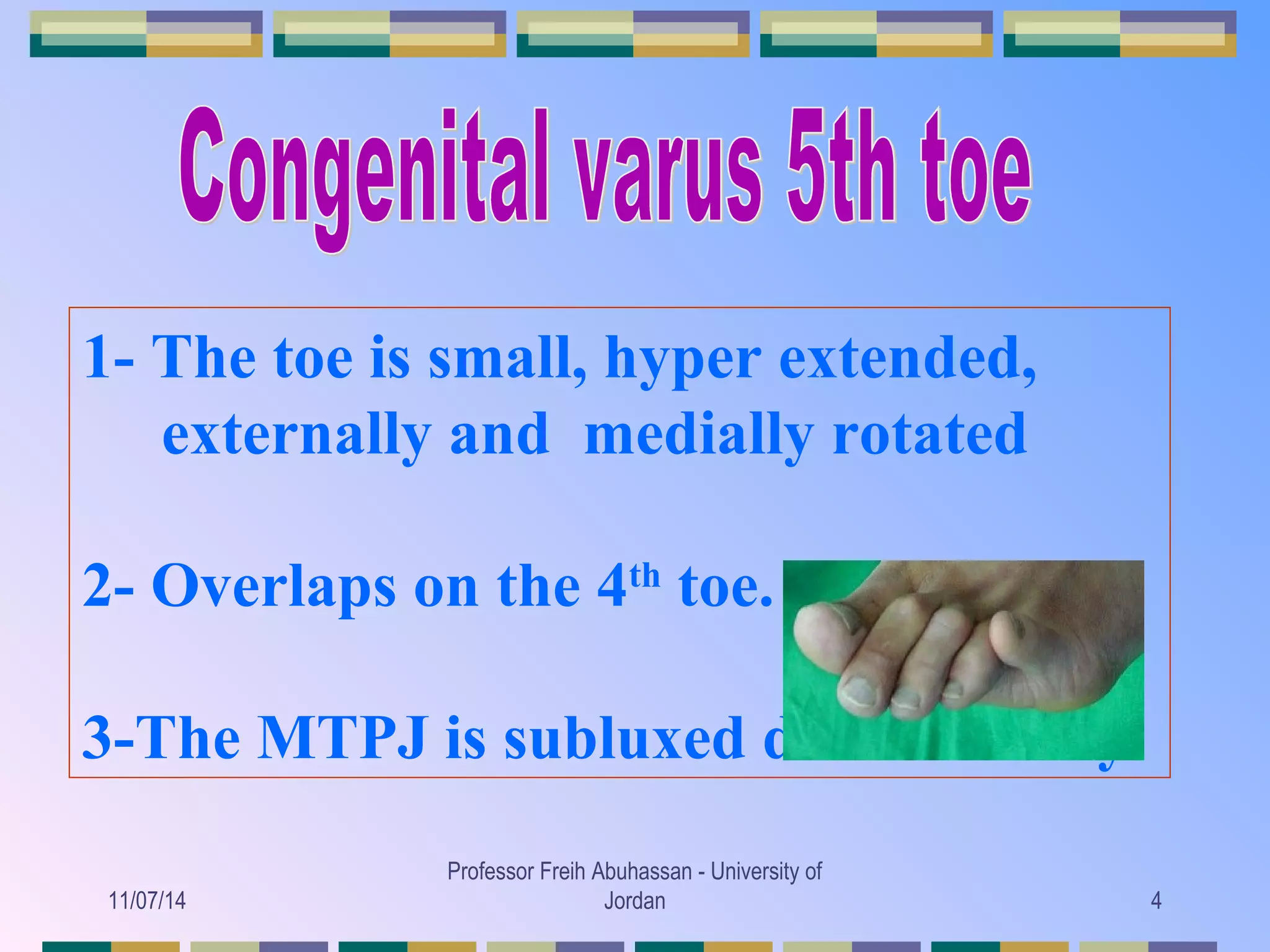 Butler's procedure overriding 5th toe - البروفيسور فريح عوده ابوحسان | PPT
