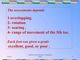 Butler's procedure overriding 5th toe - البروفيسور فريح عوده ابوحسان ...
