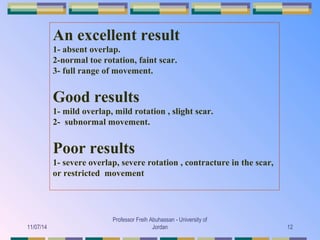 Butler's procedure overriding 5th toe - البروفيسور فريح عوده ابوحسان ...