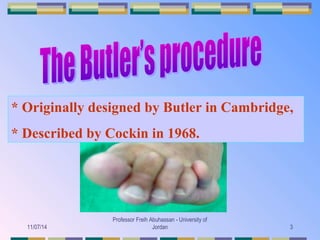 Butler's procedure overriding 5th toe - البروفيسور فريح عوده ابوحسان ...