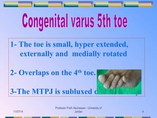Butler's procedure overriding 5th toe - البروفيسور فريح عوده ابوحسان ...