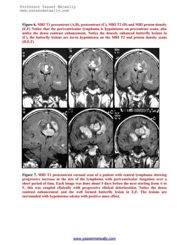 Radiological pathology of butterfly brain tumors | PDF