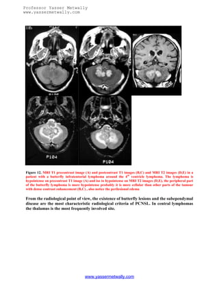 Radiological pathology of butterfly brain tumors | PDF