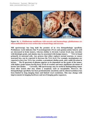 Radiological pathology of butterfly brain tumors | PDF