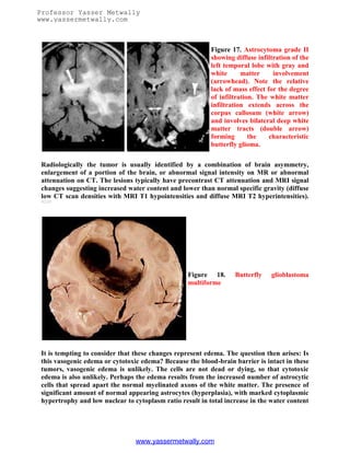 Radiological pathology of butterfly brain tumors | PDF