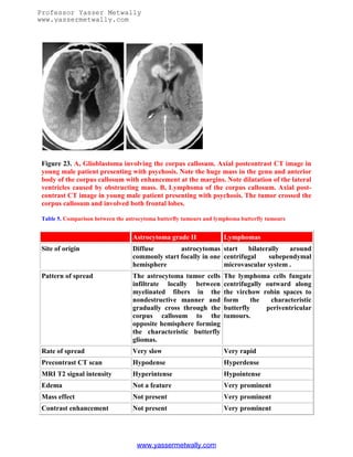 Radiological pathology of butterfly brain tumors | PDF