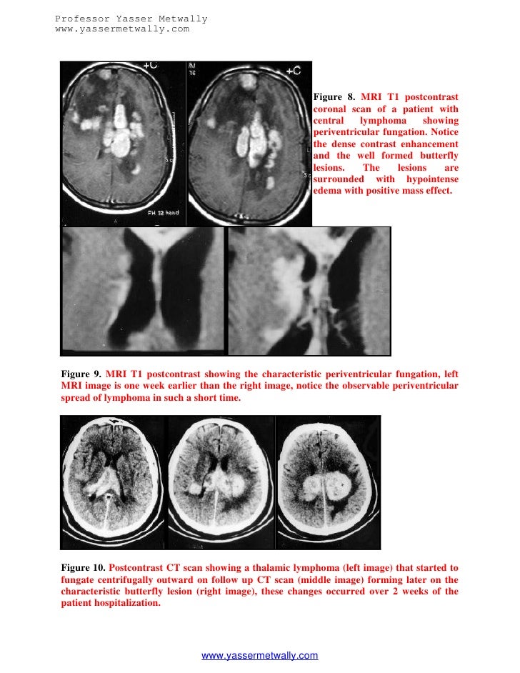 Butterfly Picture Of Lesions