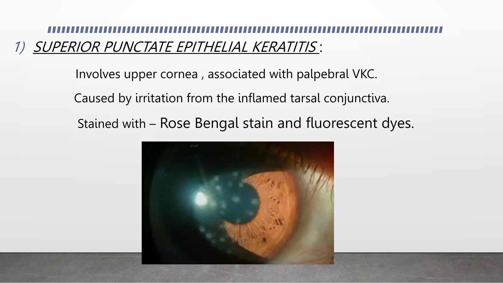 Vernal catarrh/ vernal keratoconjuctivitis | PPTX | Eye and Vision ...