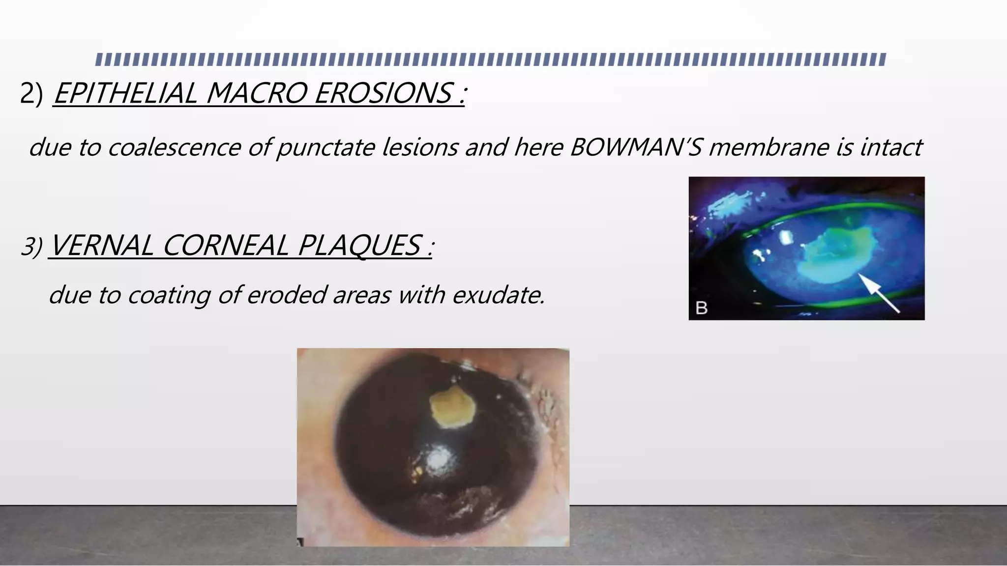 Vernal catarrh/ vernal keratoconjuctivitis | PPTX