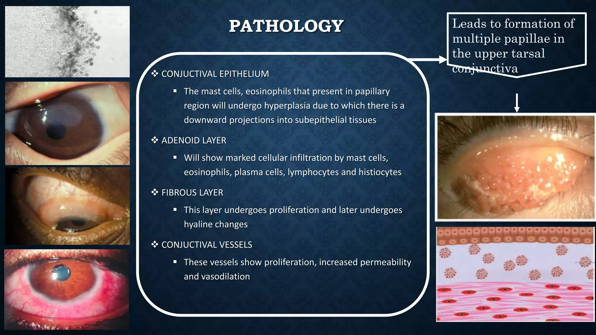 Vernal catarrh/ vernal keratoconjuctivitis | PPTX