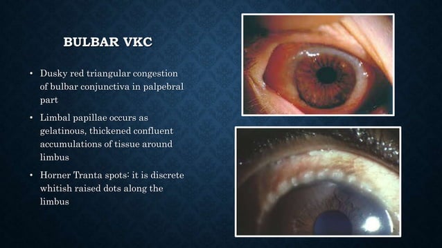 Vernal catarrh/ vernal keratoconjuctivitis | PPTX | Eye and Vision ...