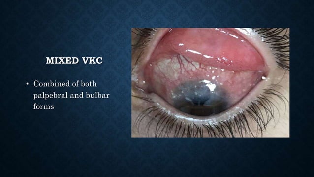 Vernal catarrh/ vernal keratoconjuctivitis | PPTX | Eye and Vision ...