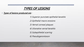 Vernal catarrh/ vernal keratoconjuctivitis | PPTX