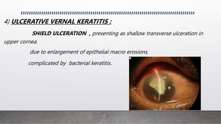 Vernal catarrh/ vernal keratoconjuctivitis | PPTX