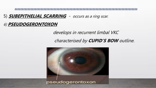 Vernal catarrh/ vernal keratoconjuctivitis | PPTX