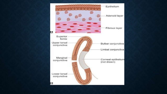 Vernal catarrh/ vernal keratoconjuctivitis | PPTX | Eye and Vision ...