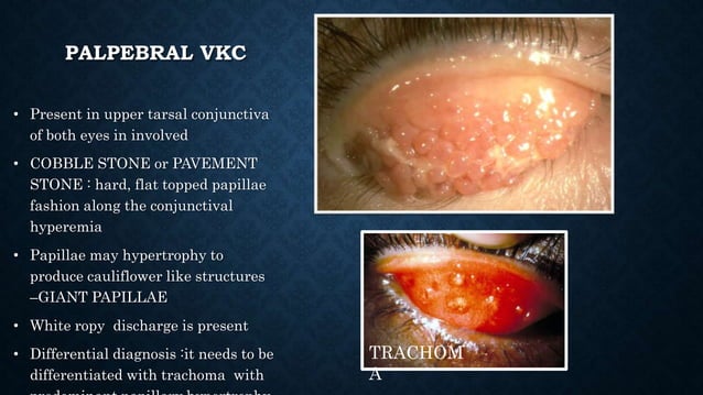 Vernal catarrh/ vernal keratoconjuctivitis | PPTX | Eye and Vision ...