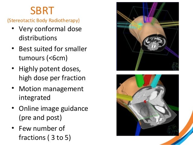 External Beam Radiotherapy for Hepatocellular carcinoma