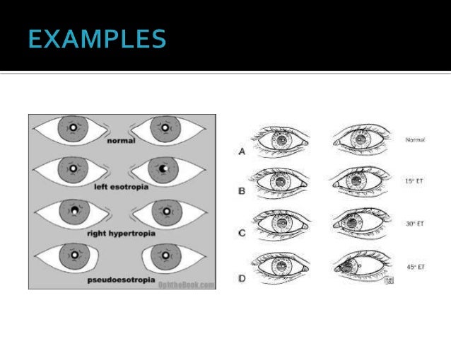 Binocular vision patient....what should I do?