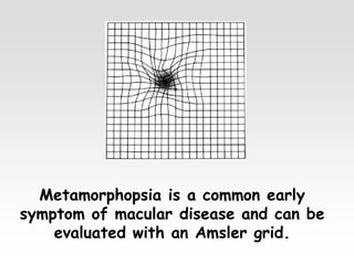 Black & White ! | PPT | Eye and Vision Conditions | Diseases and Conditions