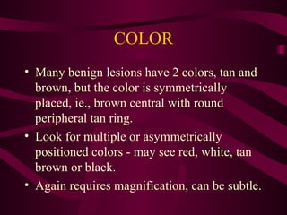 Malignant Melanoma | PPT