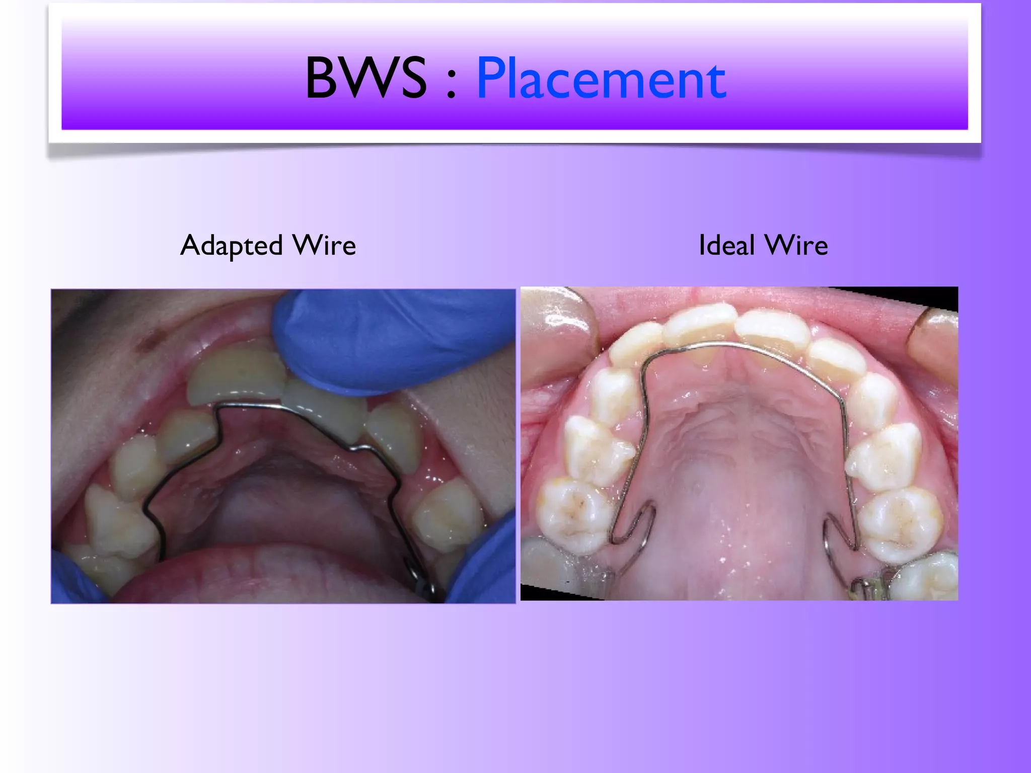 BWS placement and adjustment | PPT