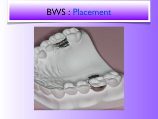 BWS placement and adjustment | PPT