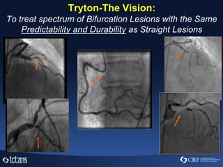 Tryton - Addressing the Challenge of Bifurcation Stenting | Dean J ...