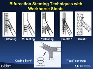 Tryton - Addressing the Challenge of Bifurcation Stenting | Dean J ...