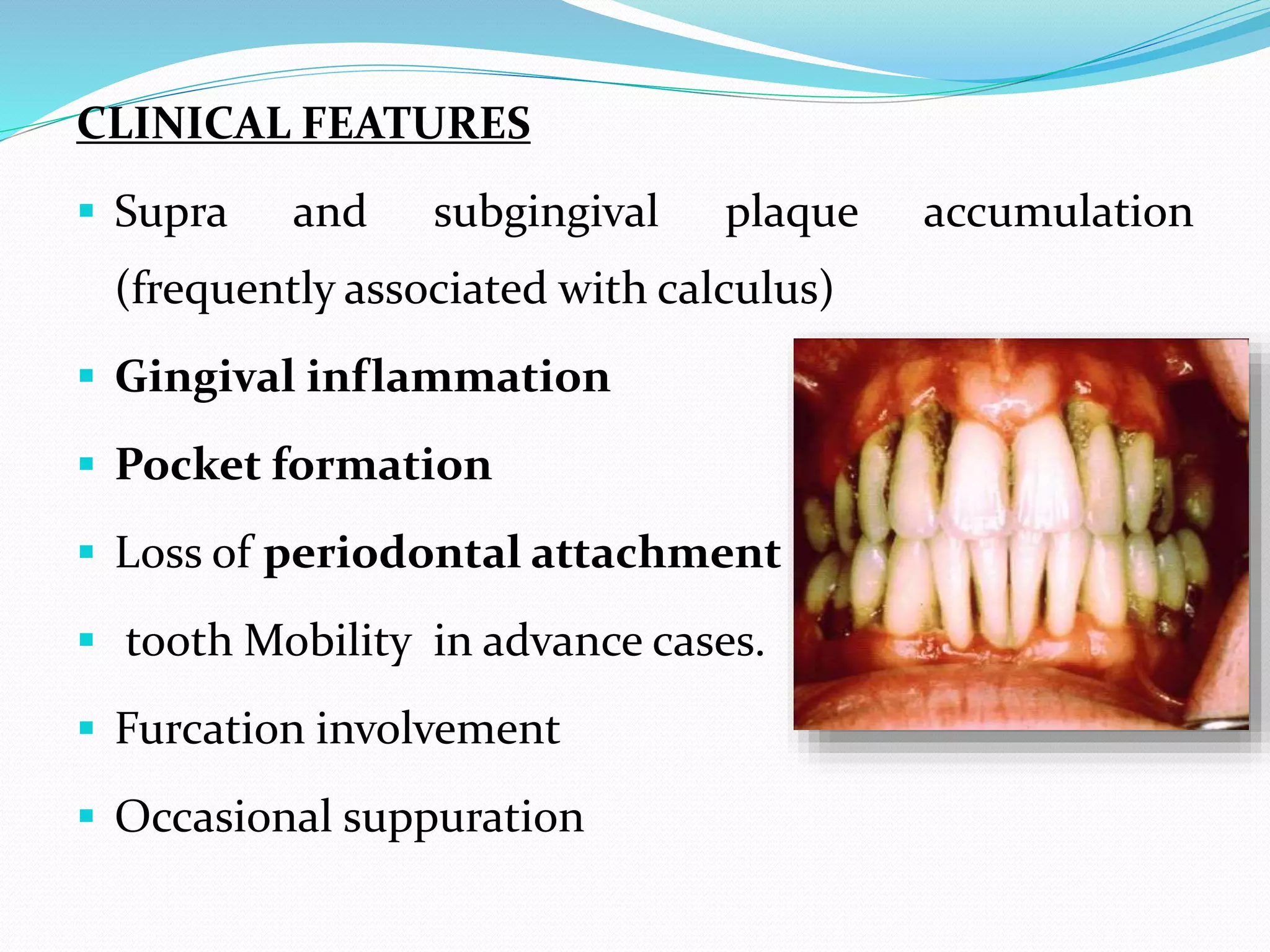 Chronic periodontitis (1) | PPTX
