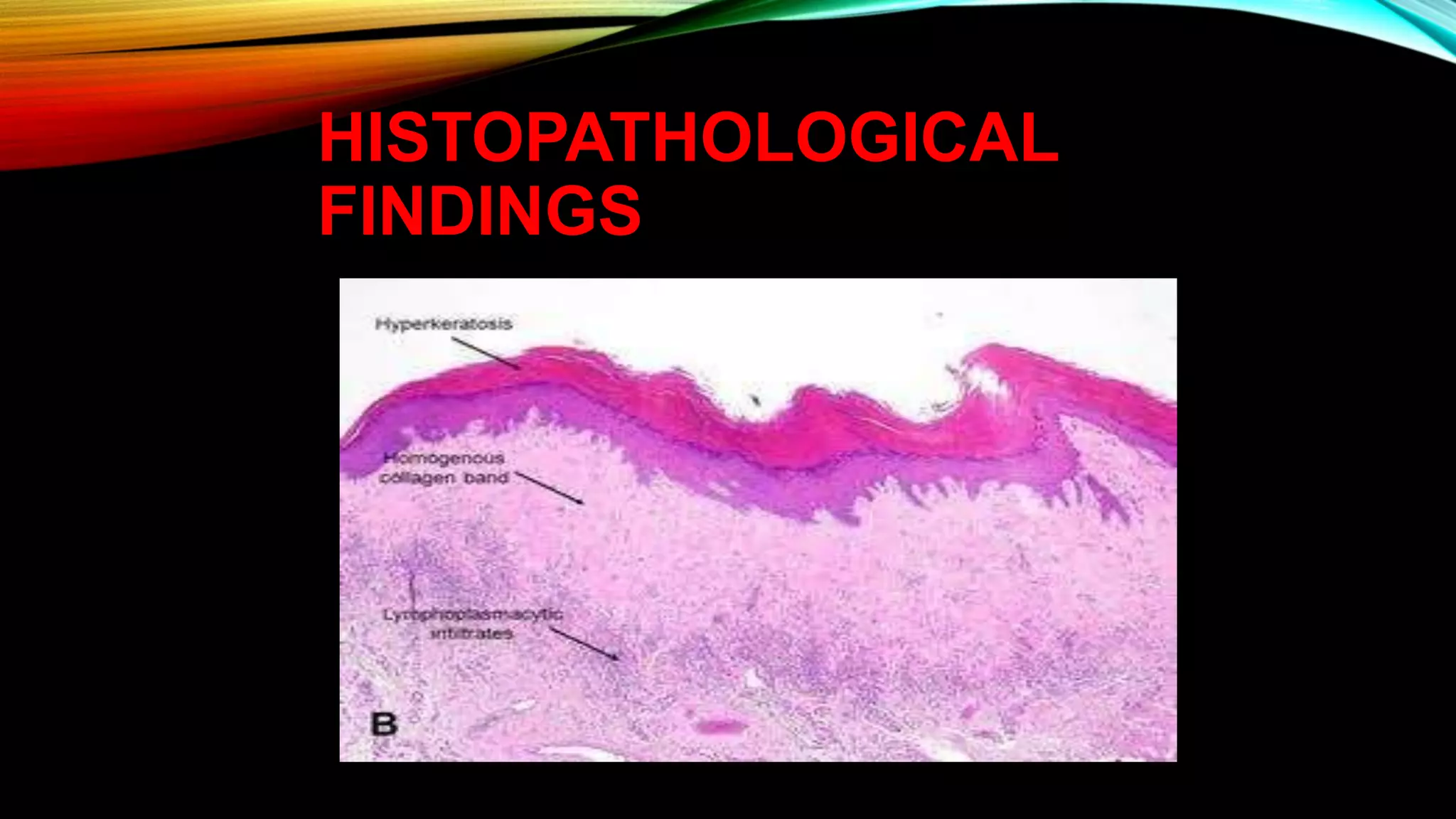 Balanitis Xerotica Obliterans / BXO / Penile Lichen Sclerosis | PPTX