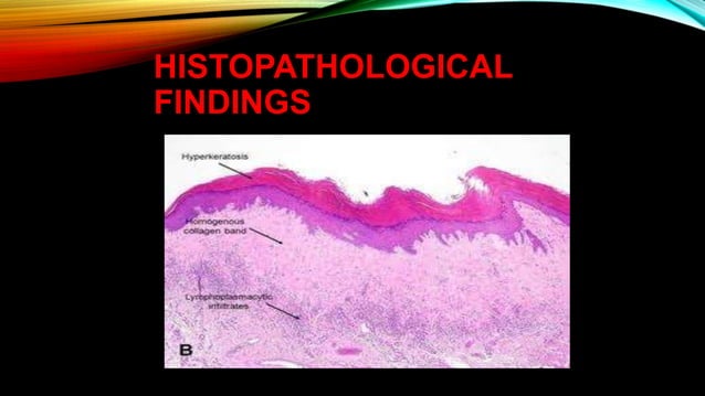 Balanitis Xerotica Obliterans / BXO / Penile Lichen Sclerosis | PPTX ...