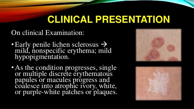 Balanitis Xerotica Obliterans / BXO / Penile Lichen Sclerosis