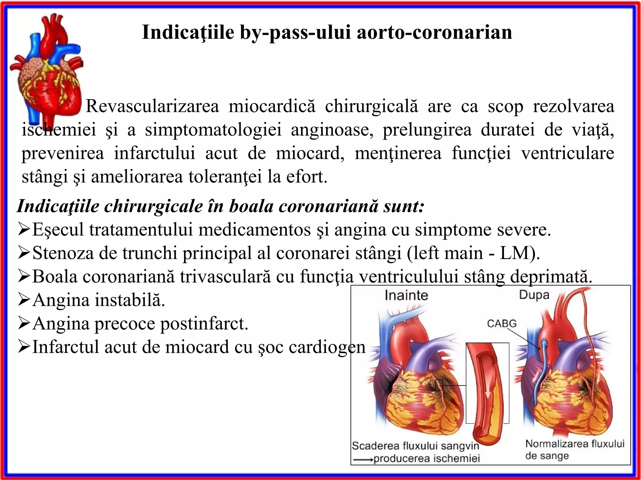 Cristina_Toteanu By-pass-ul aorto-coronarian | PDF