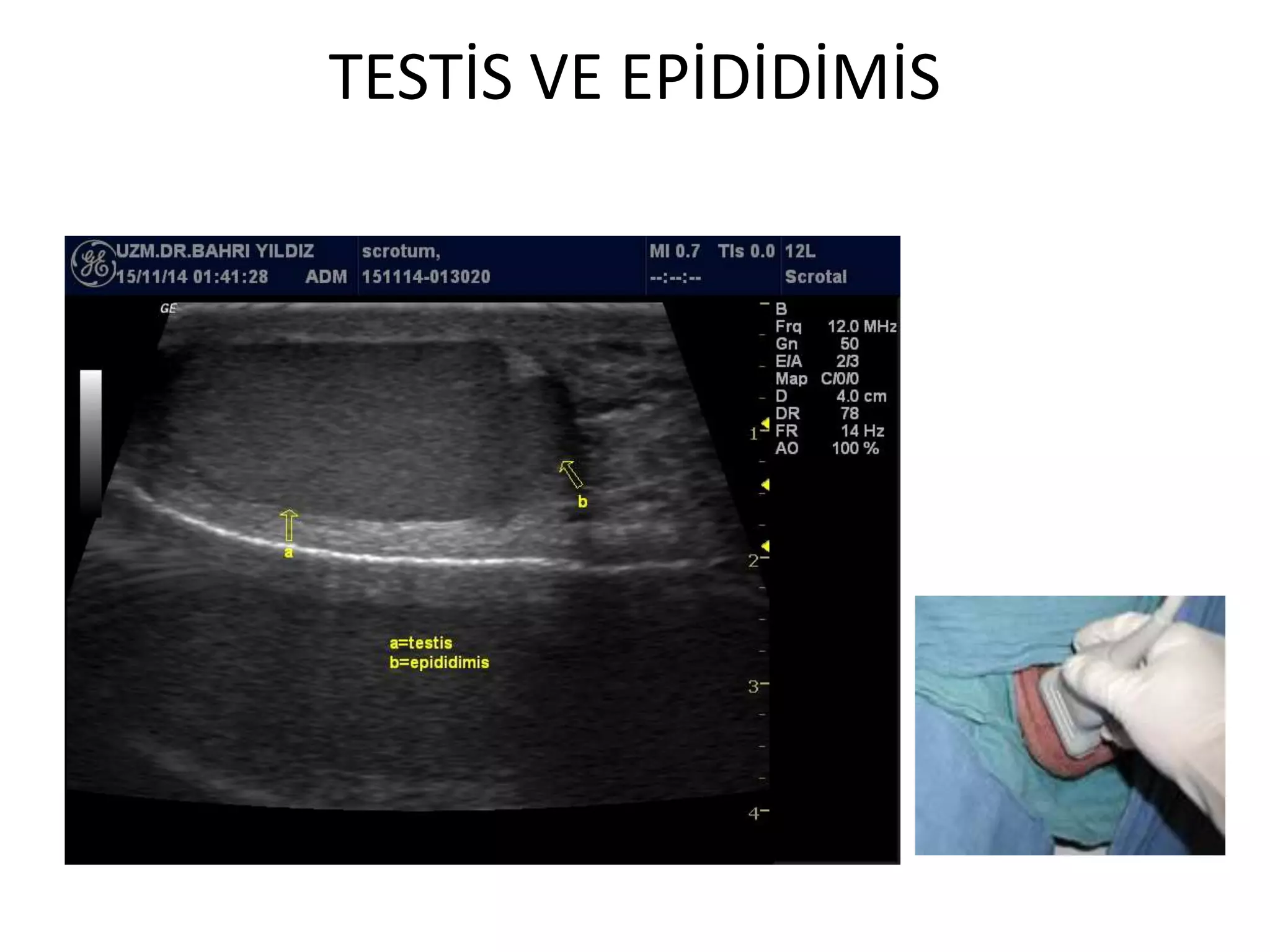 prostat ultrasonografisi | PPT