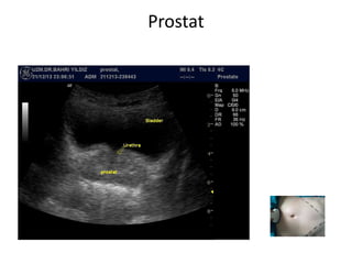 prostat ultrasonografisi | PPT