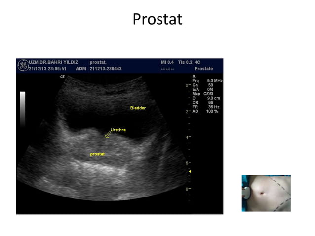 prostat ultrasonografisi | PPT