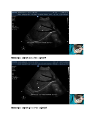 KARACİĞER ULTRASONOGRAFİSİ | DOCX