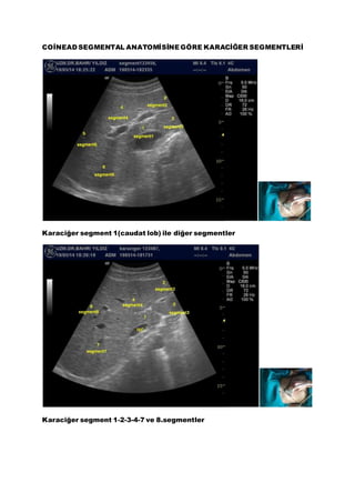 KARACİĞER ULTRASONOGRAFİSİ | DOCX