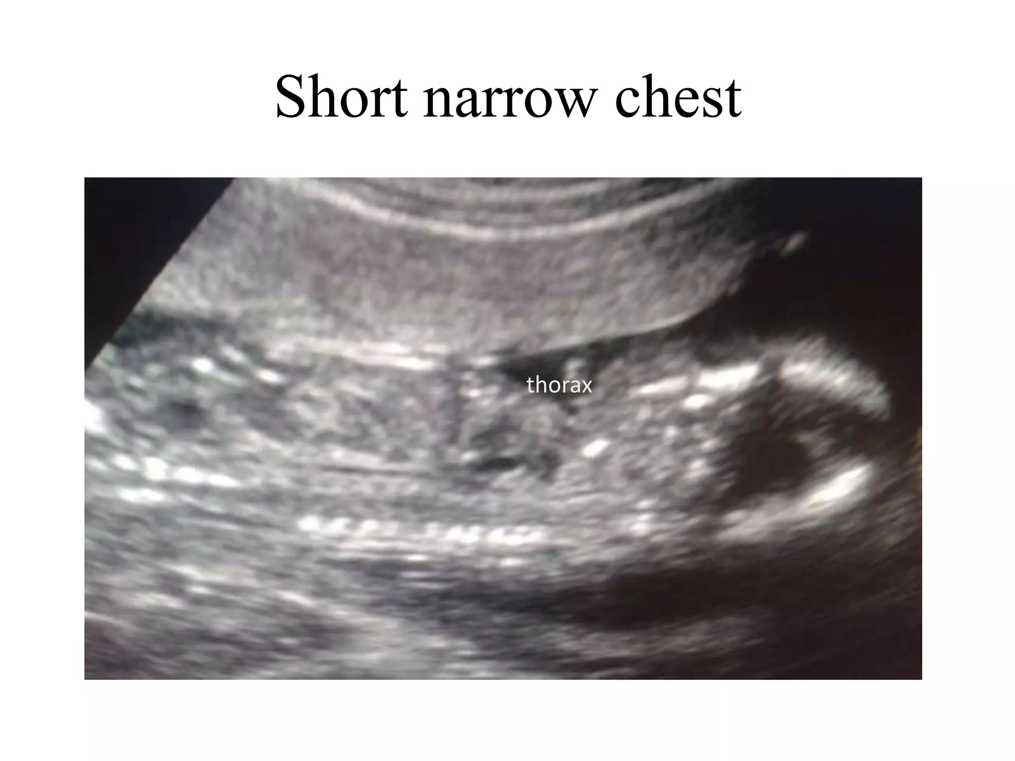 By dr. vijay sharma asphyxiating thoracic dysplasia (jeune syndrome ...