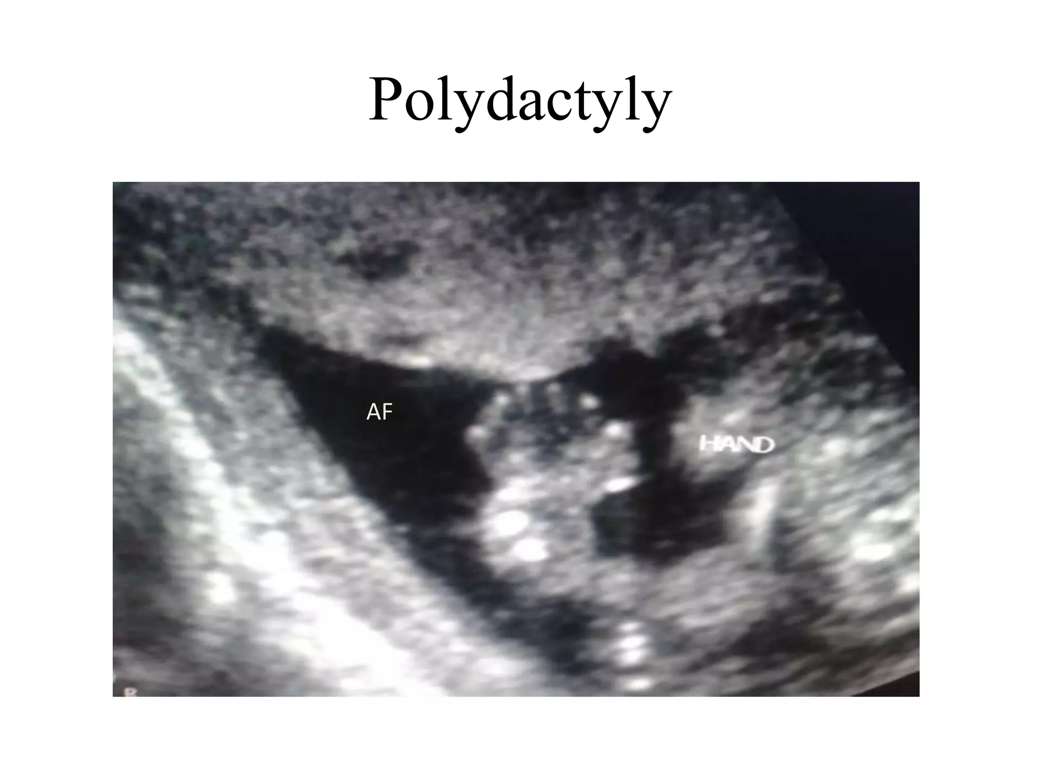 By dr. vijay sharma asphyxiating thoracic dysplasia (jeune syndrome ...